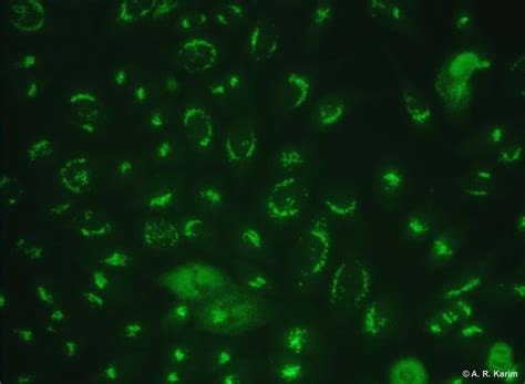 Hep 2 Cytoplasmic Staining University Of Birmingham