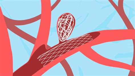 Aneurysm Treatment Options Clipping Vs Coiling Explained