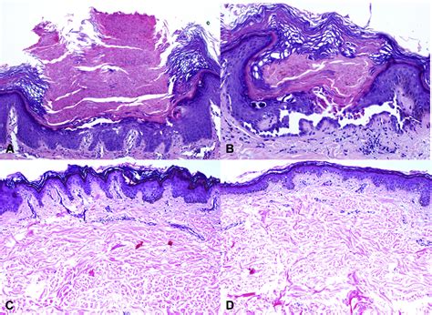 Clinicopathologic Findings Of Guttate Leukoderma In Darier Disease A Helpful Diagnostic Feature