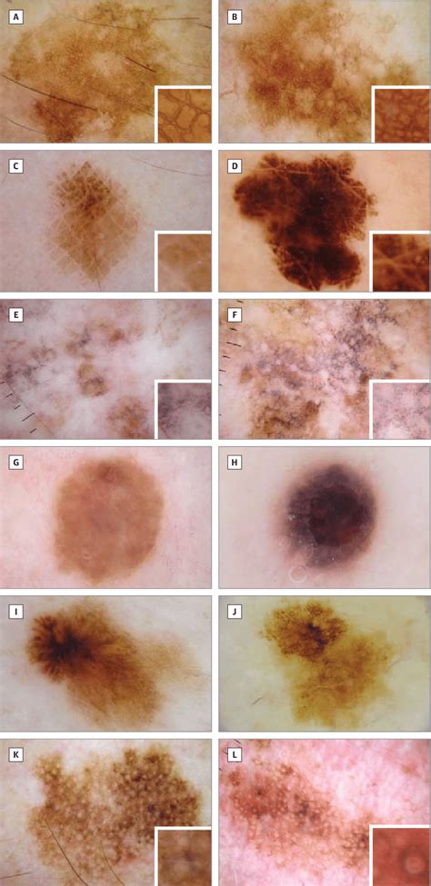 Melanoma Dermoscopic Growth Patterns Download Scientific Diagram