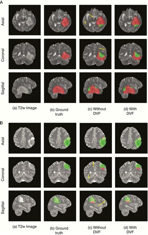 A Novel Fully Automated Mri Based Deep Learning Method For