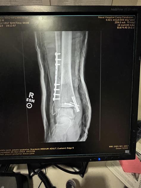 Trimalleolar Fracture Recovery Rbrokenbones