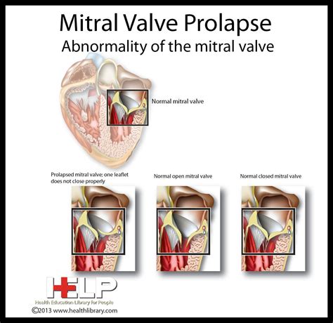 The Key To Craniotomy And Craniectomy Coding Cpt Artofit