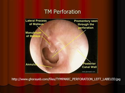 Hearing Disorders Of The Middle Ear Ppt Download