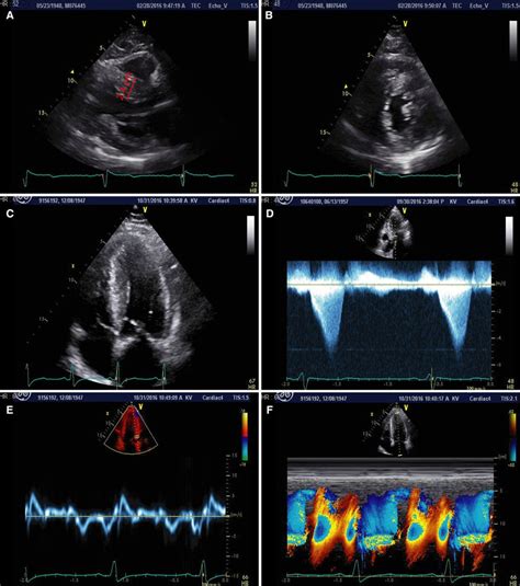Hypertrophic Cardiomyopathy Circulation Research