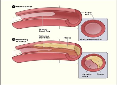 Knowledge Aterosklerosis