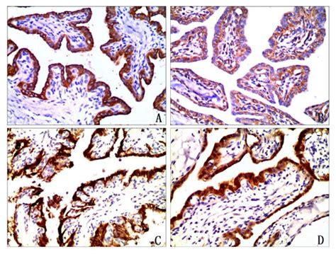 Immunophenotype Of Endolymphatic Sac Tumor A The Tumor Cells Showed Download Scientific