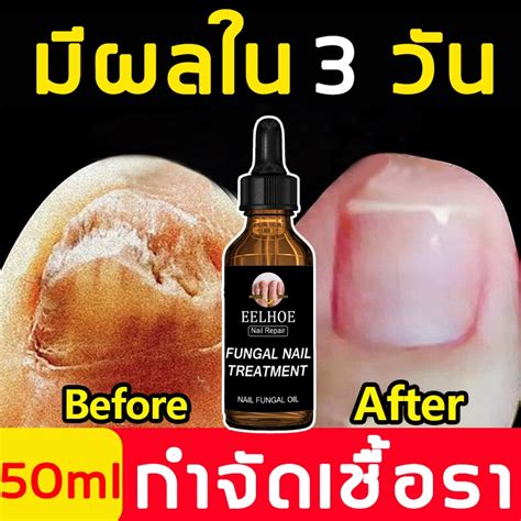 เซรั่มบำรุงเล็บ Eelhoe รักษาเชื้อราเล็บ รักษาเล็บขบ ฆ่าเชื้อราที่เล็บ น้ำยาบำรุงเล็บ เชื้อราที่