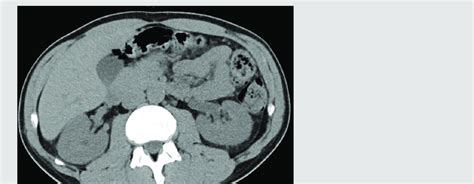 Non Contrast Enhanced Computed Tomography Ct Revealed A Left Hydroureter Download