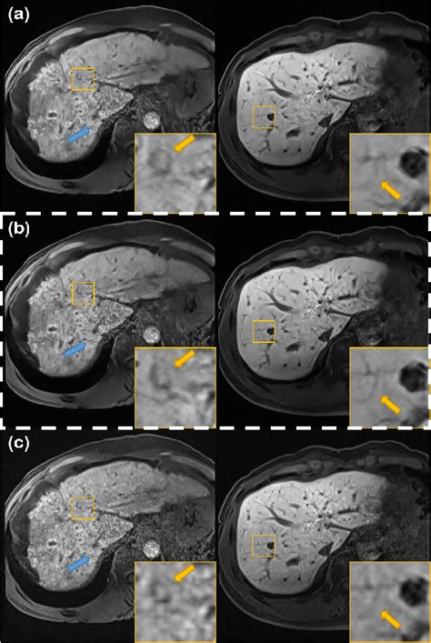 figure 5 from mr image denoising and super resolution using regularized