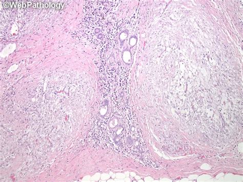 Nodular Fasciitis Breast