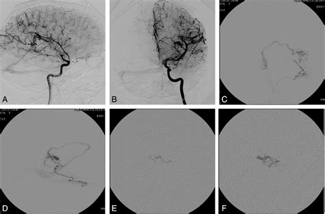 Figure 1 From Embolizationmalformations With Transvenous Onyx Hemorrhagic Brain Arteriovenous