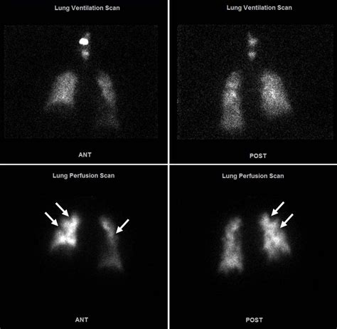 Ventilationperfusion Lung Scan Anterior View A And Posterior View Download Scientific
