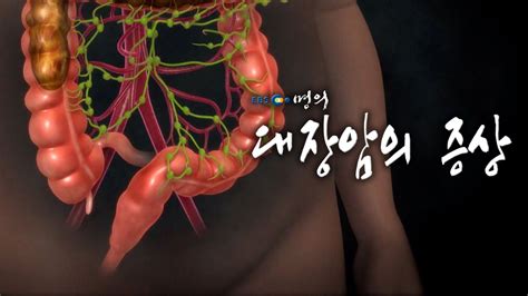 [명의 의학백과📖] 대장암의 증상 Youtube