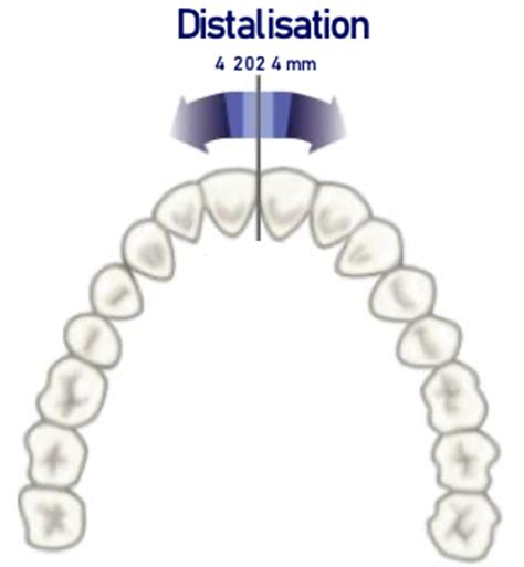 Types Of Orthodontic Tooth Movement