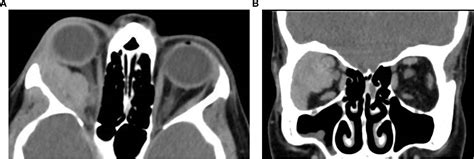 Frontiers Orbital Masses A Review Of Ct Imaging Characteristics