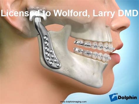Best Guide What Is Tmj Replacement Surgery Dr Larry M Wolford Dmd