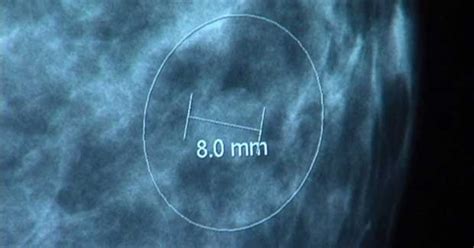 Mastectomy Or Lumpectomy Choice For Breast Cancer Varies Across Country Report