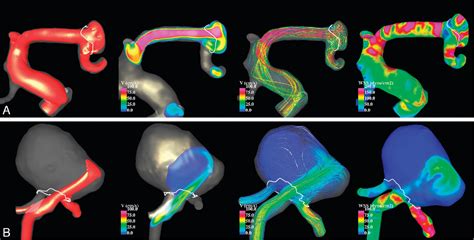 Figure 2 From And Cerebral Aneurysm Rupture Association Of Hemodynamic