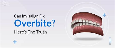Can Invisalign Fix Overbite Heres The Truth La Dental