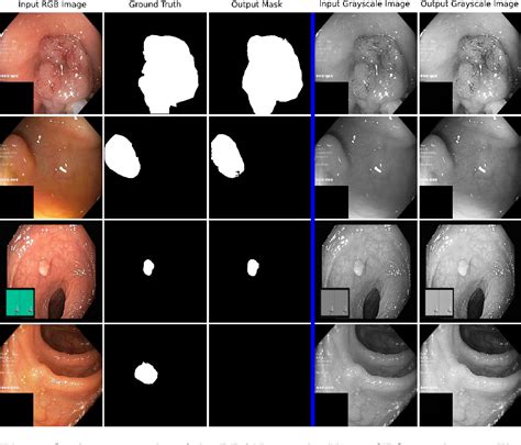 Ddanet Dual Decoder Attention Network For Automatic Polyp Segmentation