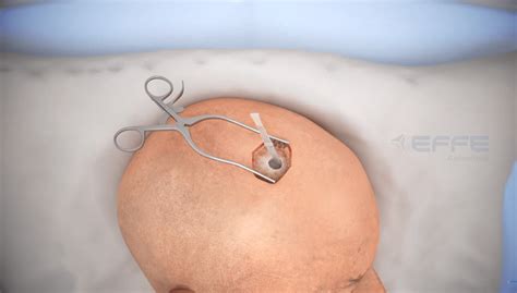 Brain Surgery Anatomy Animation Services 3d Visuals