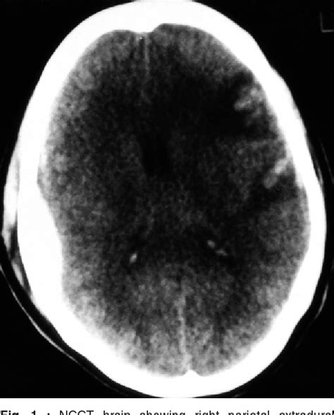 Figure 1 From Transitory Alexia Without Agraphia Following Head Injury