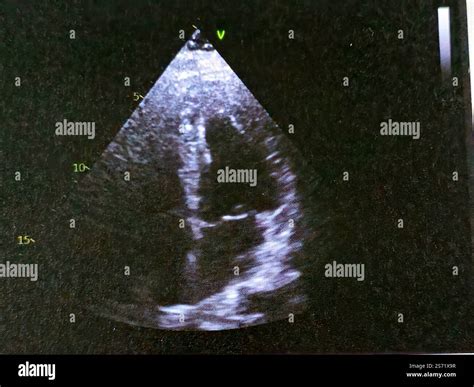 Echocardiography Or Cardiac Ultrasound Shows Normal Values Except For Left Ventricular