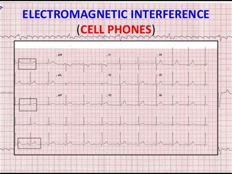 Ecg Artifacts And Pitfalls