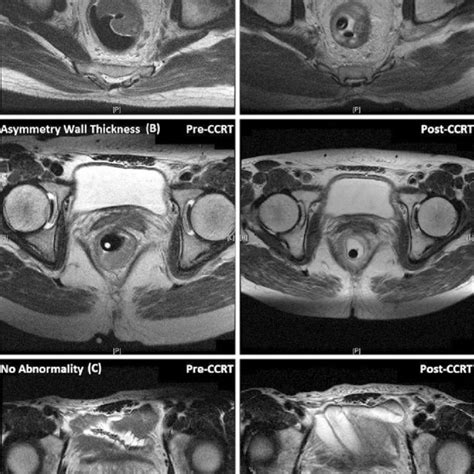 Endoscopic View Of Rectal Cancer Before Left And After Right