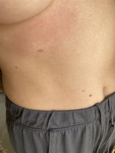 Splotchy Rash On Chest That Comes And Goes Plus One Spot On Foot R Dermatology