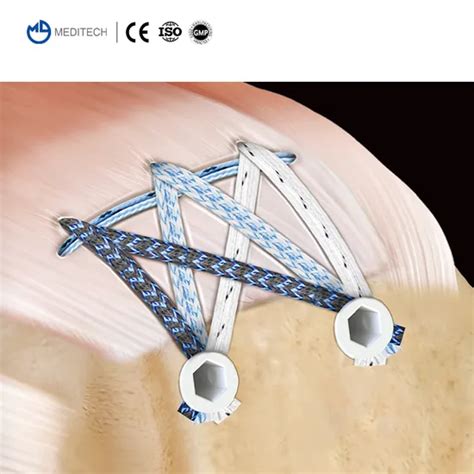 All Suture Anchor Absorbable Suture Anchor Achilles Tendon Suture Anchor Shoulder Arthroscopy