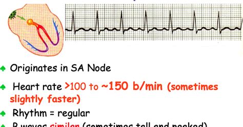 Sinus Tachycardia