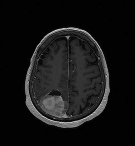 Brain Cancer Tumor Mri