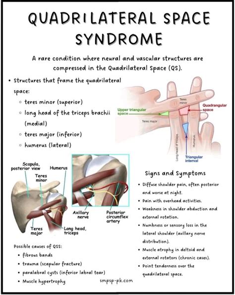 W Understanding Quadrilateral Space Syndrome Qss Qss Is A Rare
