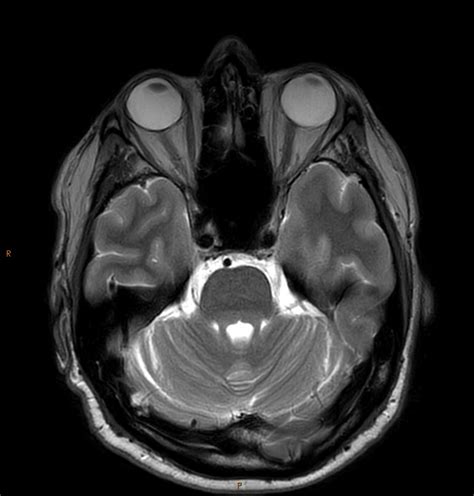File Diffuse Astrocytoma IDH Mutant Radiopaedia 98918 120113 Axial 15 NC Commons
