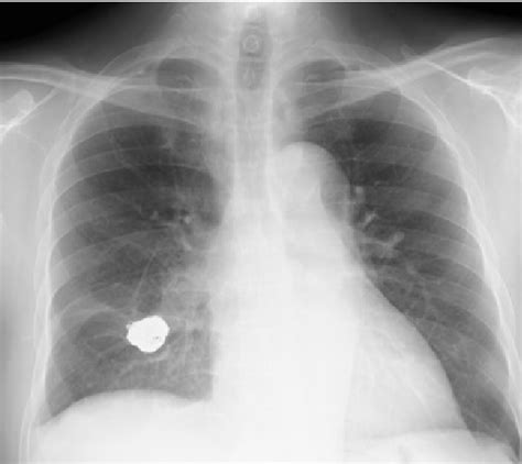 Figure 1 From Successful Intrasaccular Coil Embolization Of Mycotic Pulmonary Artery