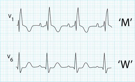 Right Bundle Branch Block Rbbb • Litfl • Ecg Library Diagnosis