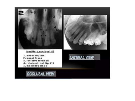 Development Anatomy And Histology Of Maxillary Sinus Pptx