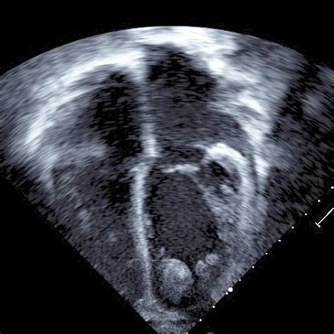 Echocardiography Of Case 4 Showing Large Thrombus Seen In The Left