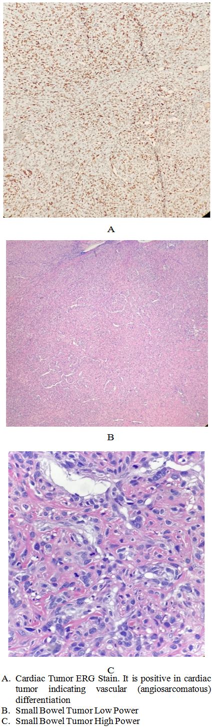 Figure 5 Resected Cardiac Mass Pathology A Rare Case Of High Grade