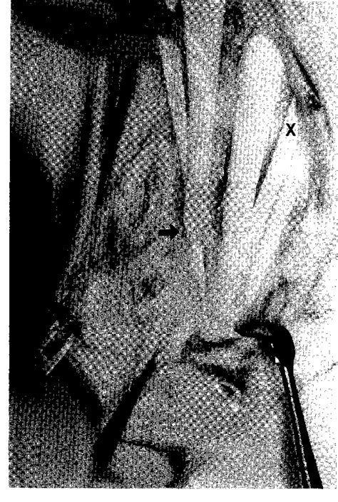 Figure 3 From Rupture Of The Extensor Digitorum Communis Tendons Caused