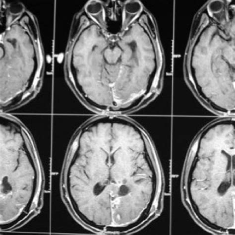 Postoperative Magnetic Resonance Imaging Download Scientific Diagram