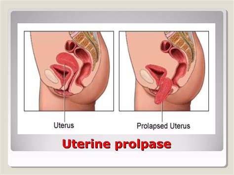 Utero Vaginal Prolapse Ppt