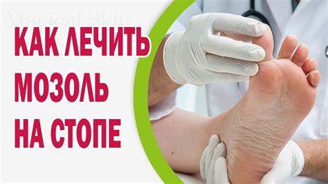 Как лечить мозоль на стопе: медицинские и народные средства - YouTube