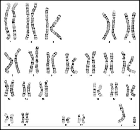 Chromosomal Analysis Of Proband Download Scientific Diagram