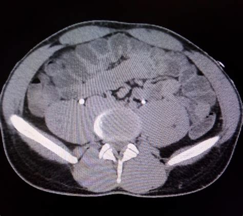 Bladder Exstrophy Ct Sumers Radiology Blog