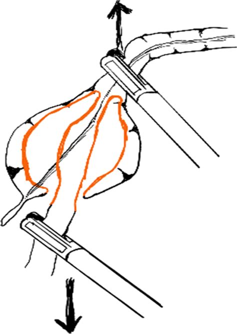 Schematic Diagram Of Reduction Of Intussusception By Pulling Ileum