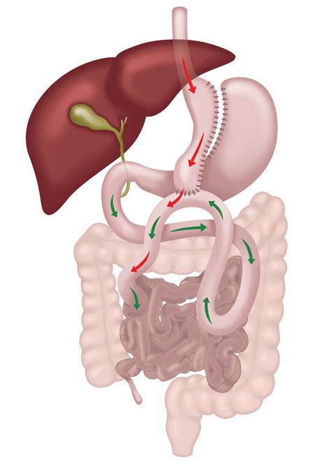 Mini Gastric Bypass Oagb Wa Weight Loss Centre