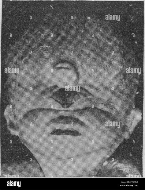 Cyclops Human Disorder